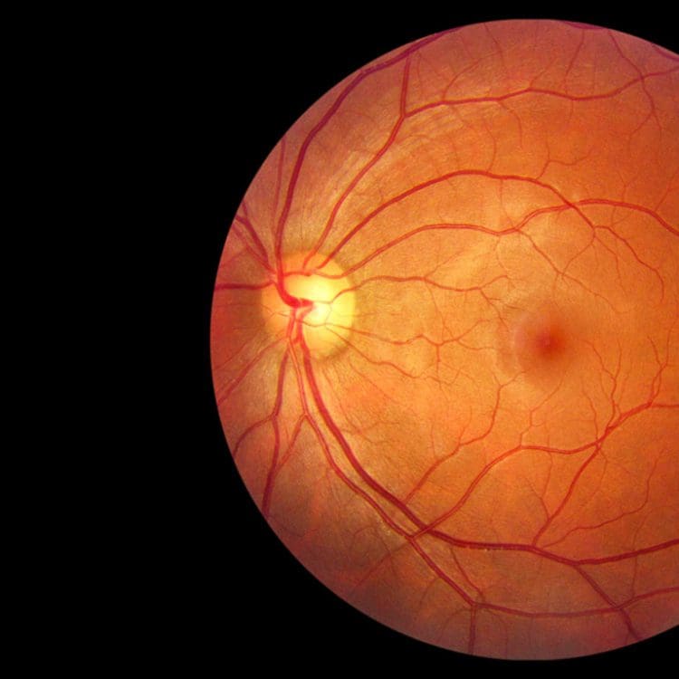 Epiretinal Membrane | LaserVision