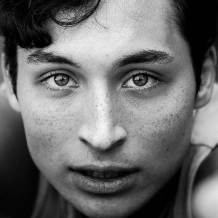 Droopy Eyelids (Ptosis) | LaserVision