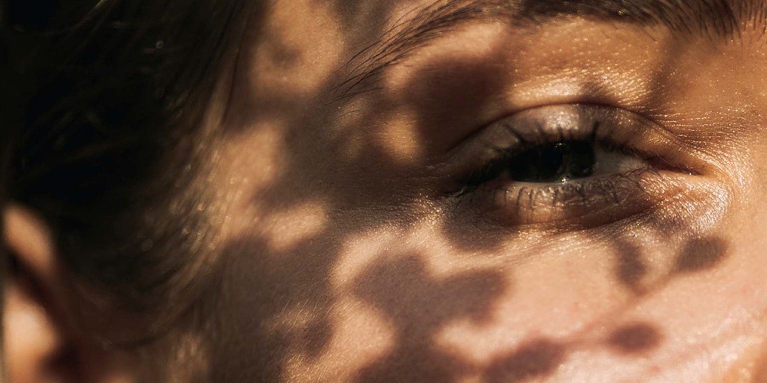 Cystoid Macula Oedema (CMO) | LaserVision